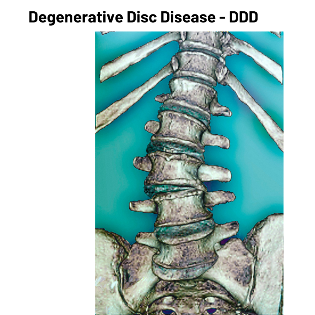 DEGENERATIVE DISC DISEASE (DDD)