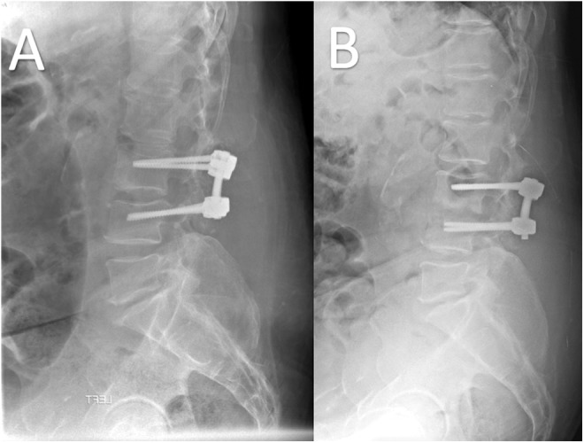 RISKS OF POSTOPERATIVE SPINE INFECTION | Non Surgical Spinal Care